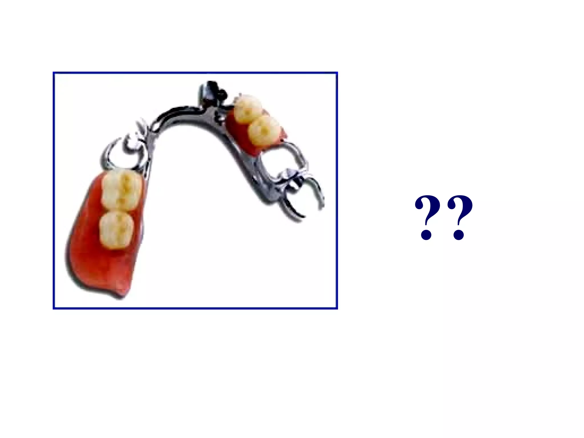 02 classification and indications of rpd | PPT