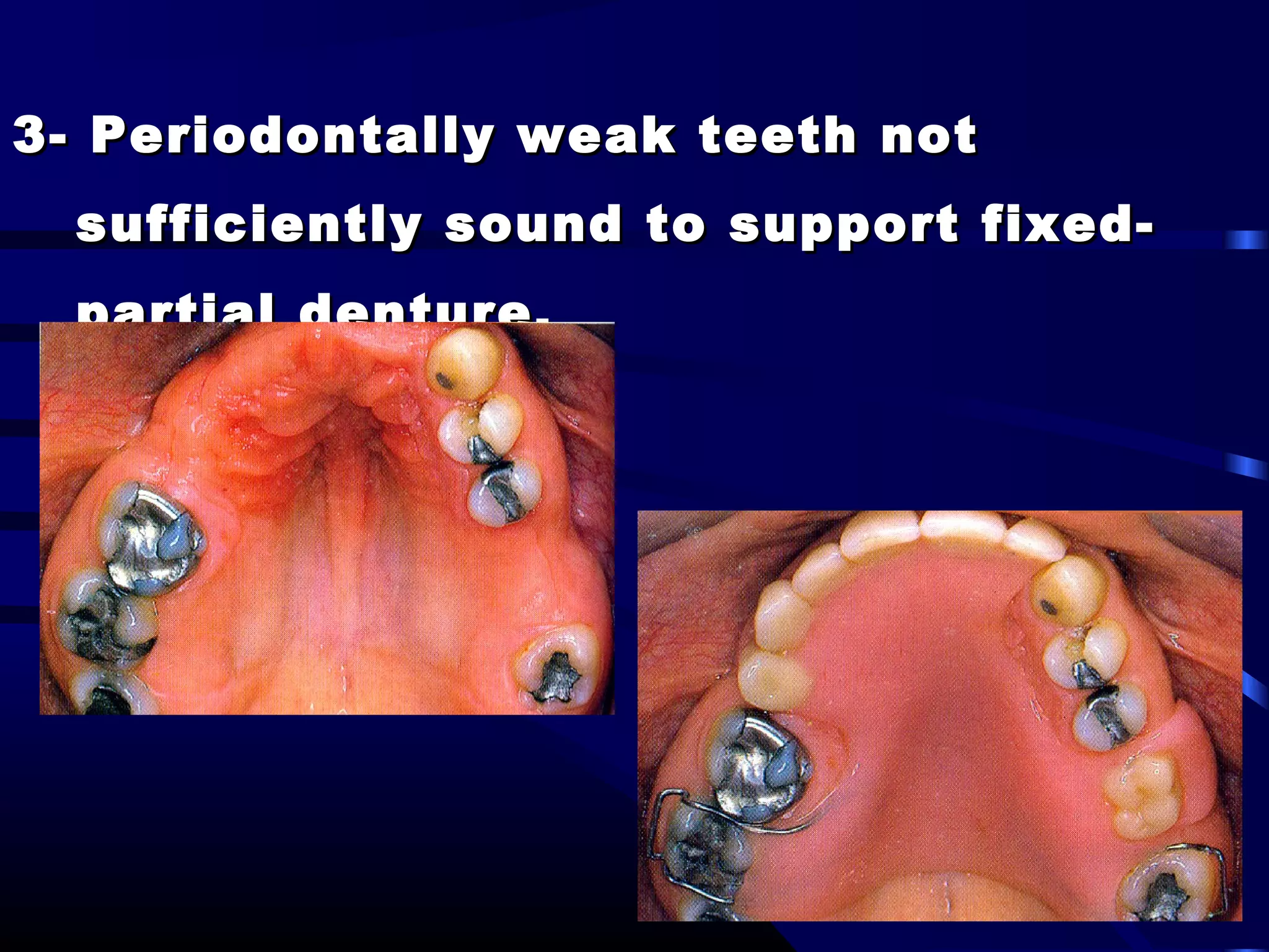 02 classification and indications of rpd | PPT