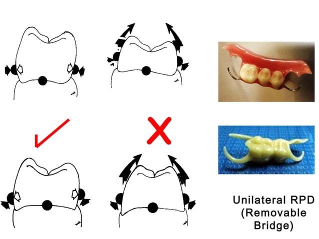02 classification and indications of rpd | PPT