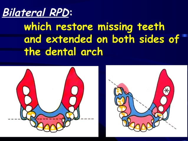 02 classification and indications of rpd | PPT
