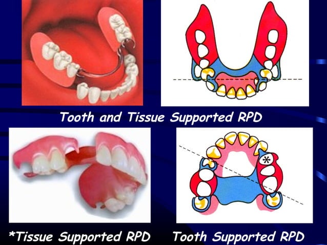 02 classification and indications of rpd