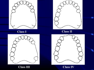 02 classification and indications of rpd