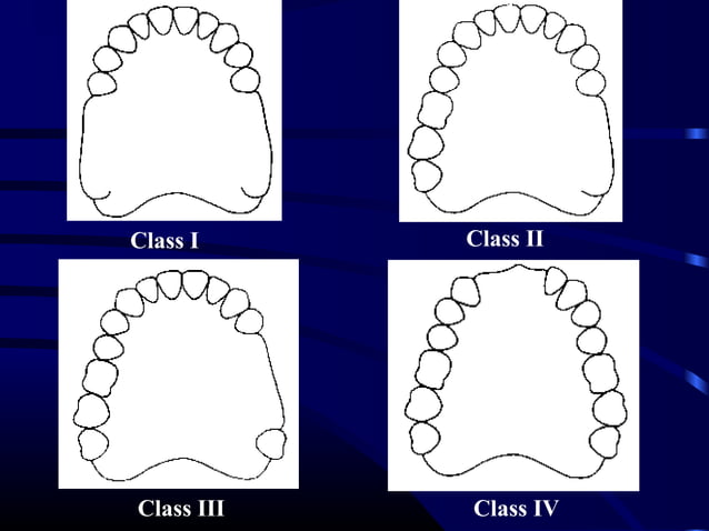 02 classification and indications of rpd | PPT