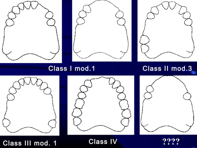 02 classification and indications of rpd | PPT