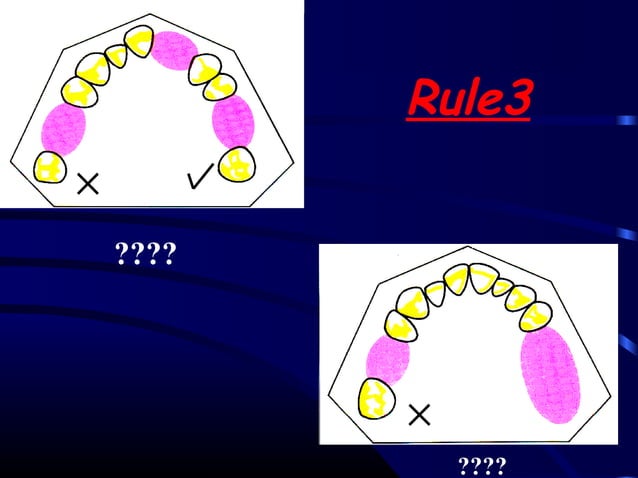 02 classification and indications of rpd | PPT