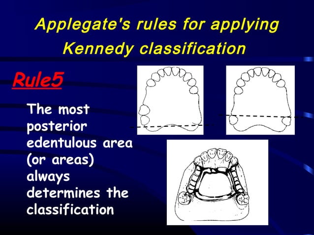 02 classification and indications of rpd | PPT
