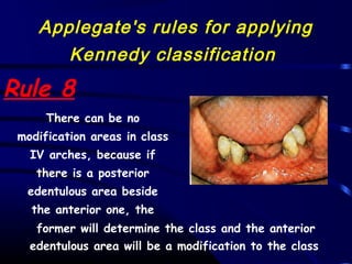 02 classification and indications of rpd | PPT