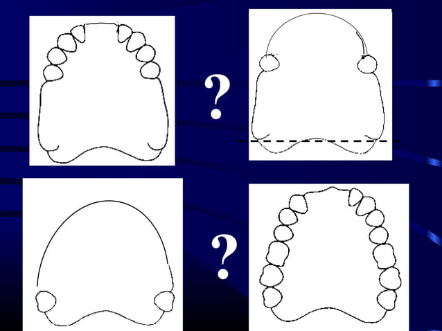 02 classification and indications of rpd | PPT