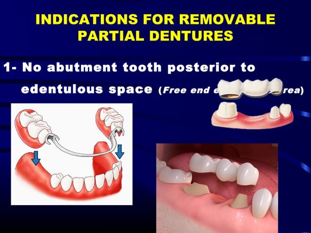 02 classification and indications of rpd | PPT