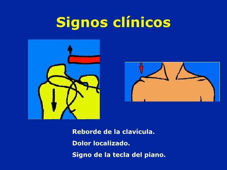 02 Clavicula Fractura Lux Ac Cl