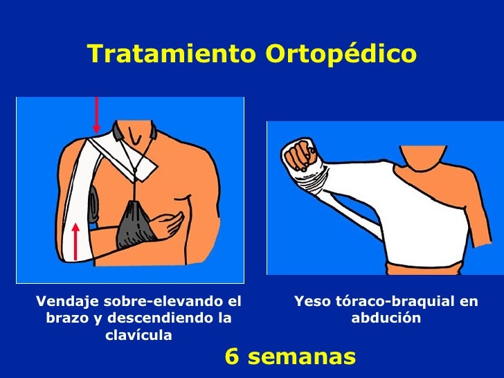 02 Clavicula Fractura Lux Ac Cl