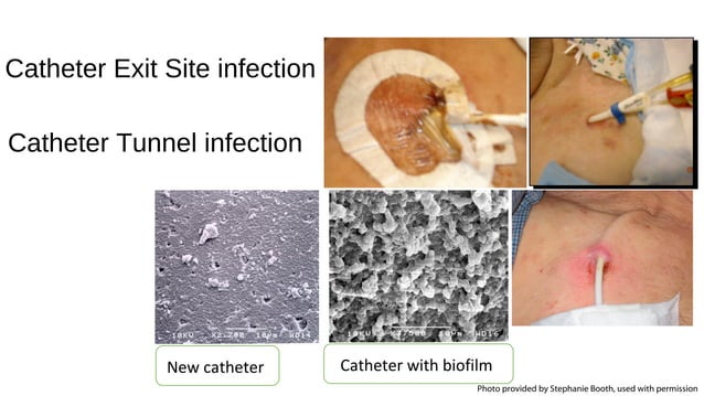 hemodialysis catheter infection | PPT