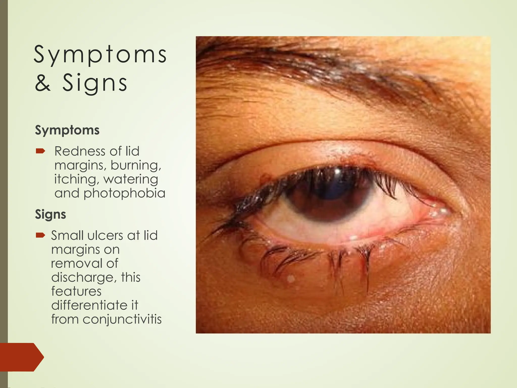 02 DISEASES OF THE EYE LIDS (1).pdf medicine | PPT