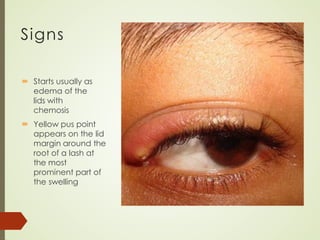02 DISEASES OF THE EYE LIDS (1).pdf medicine | PDF
