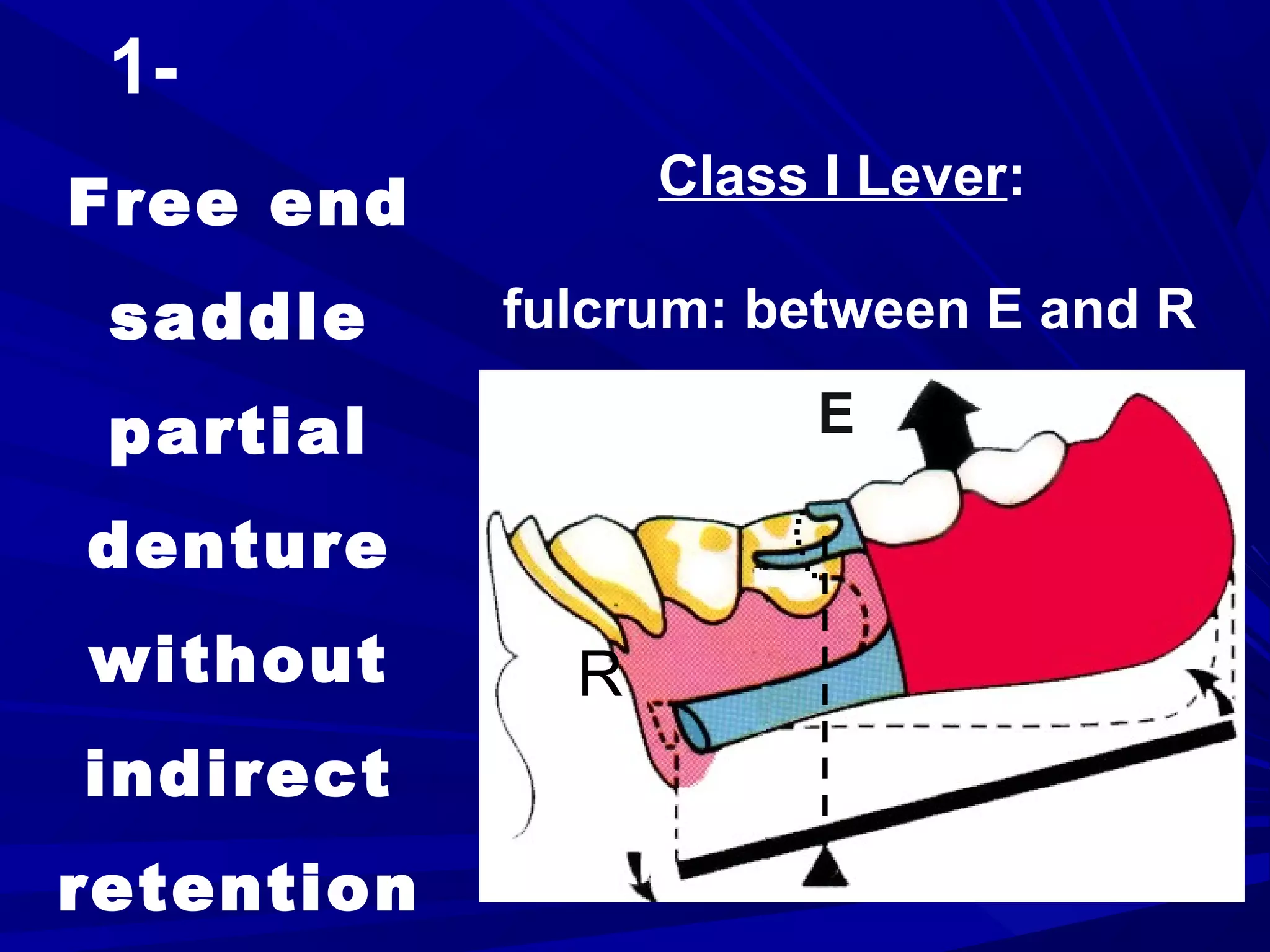 1. forces acting on rpd | PPT