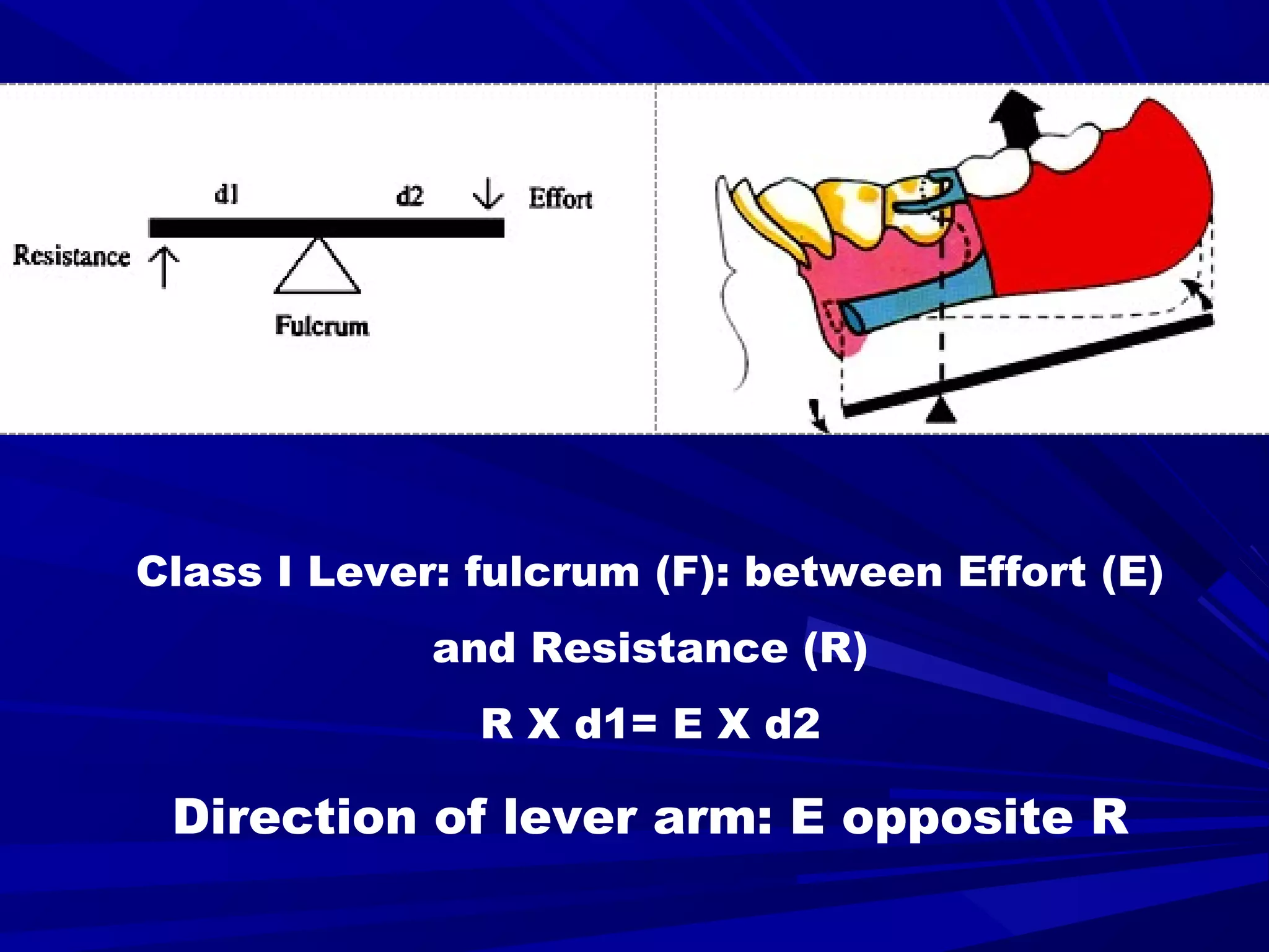 1. forces acting on rpd | PPT