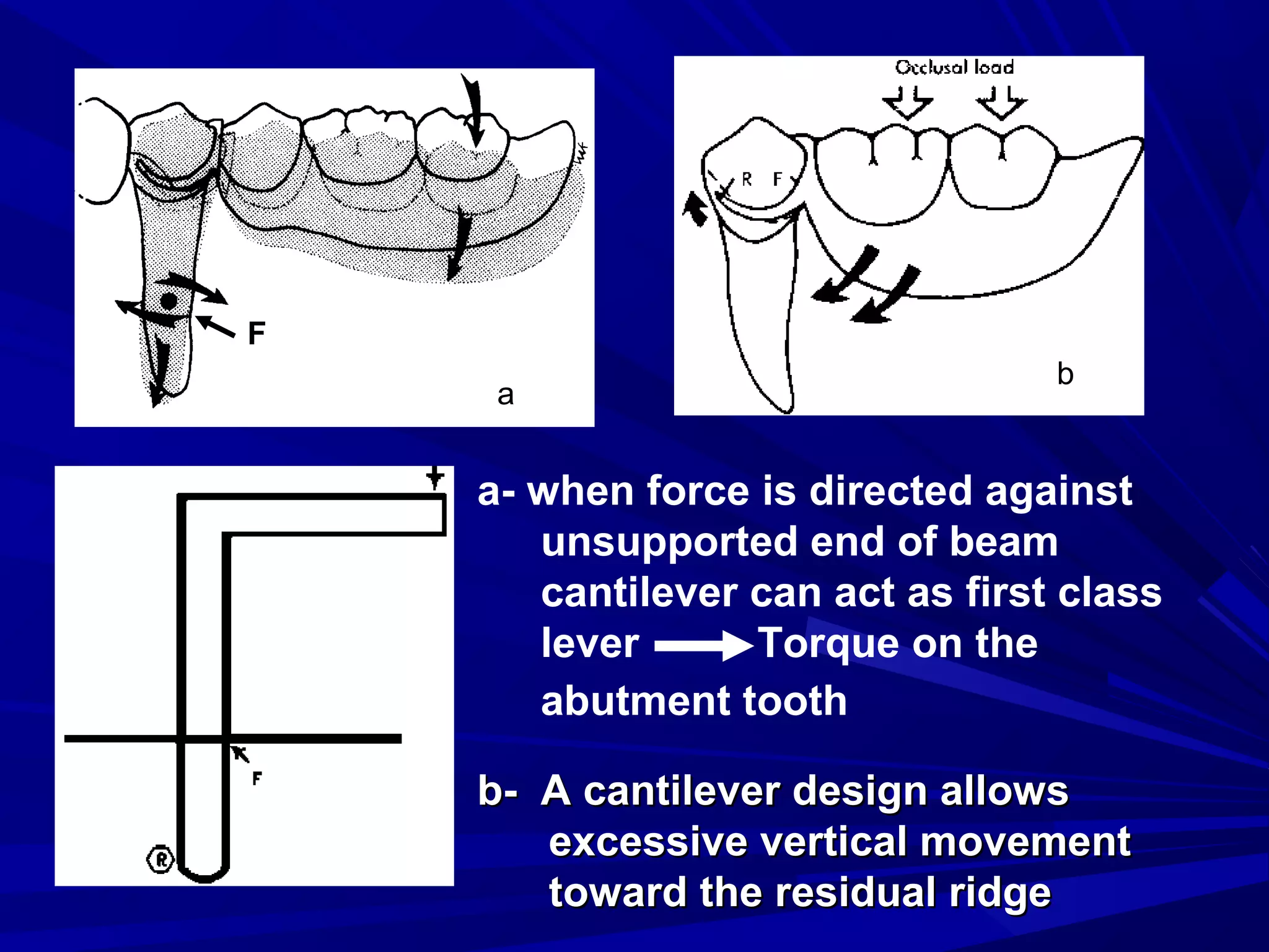 1. forces acting on rpd | PPT
