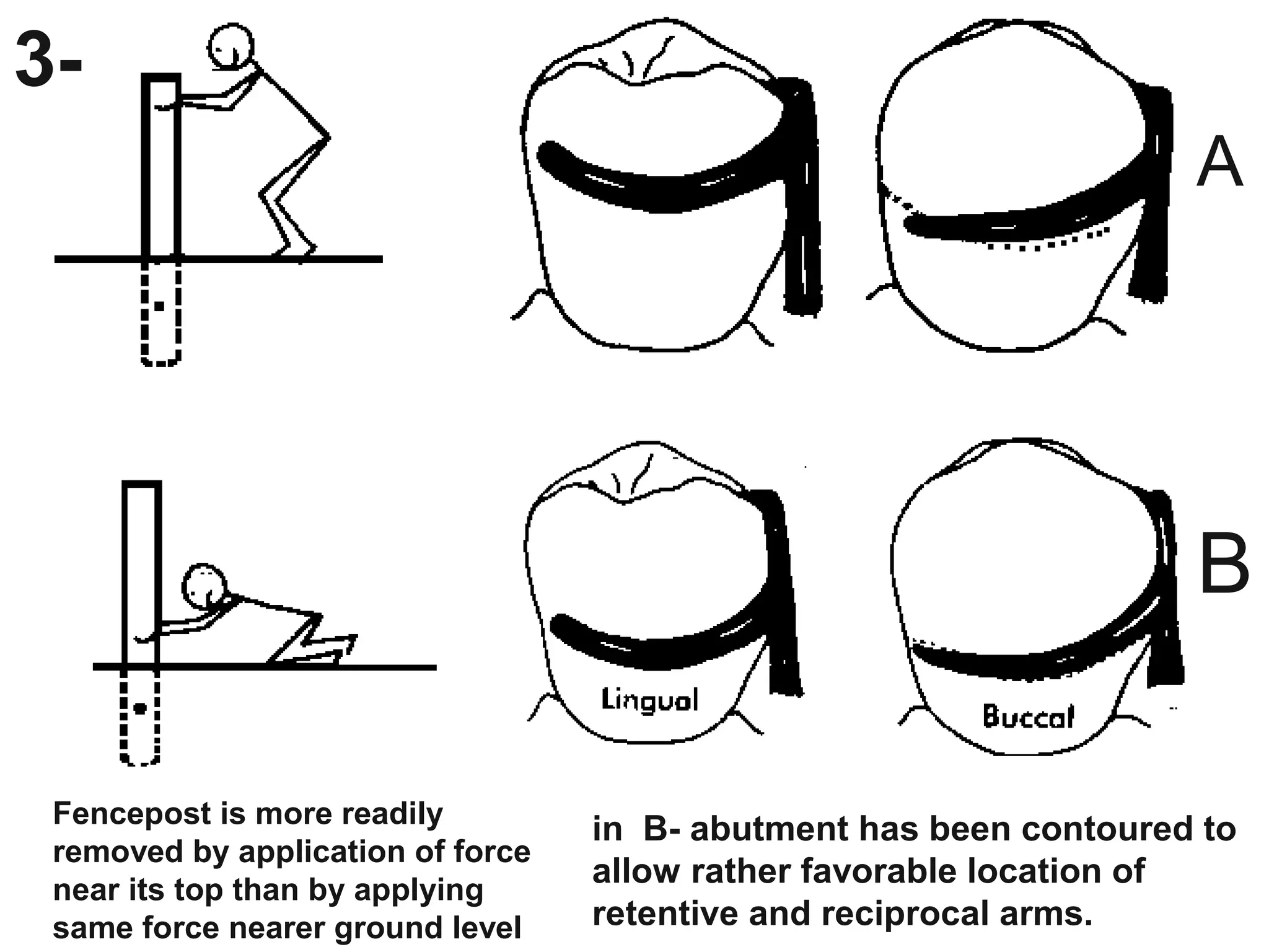 1. forces acting on rpd | PPT
