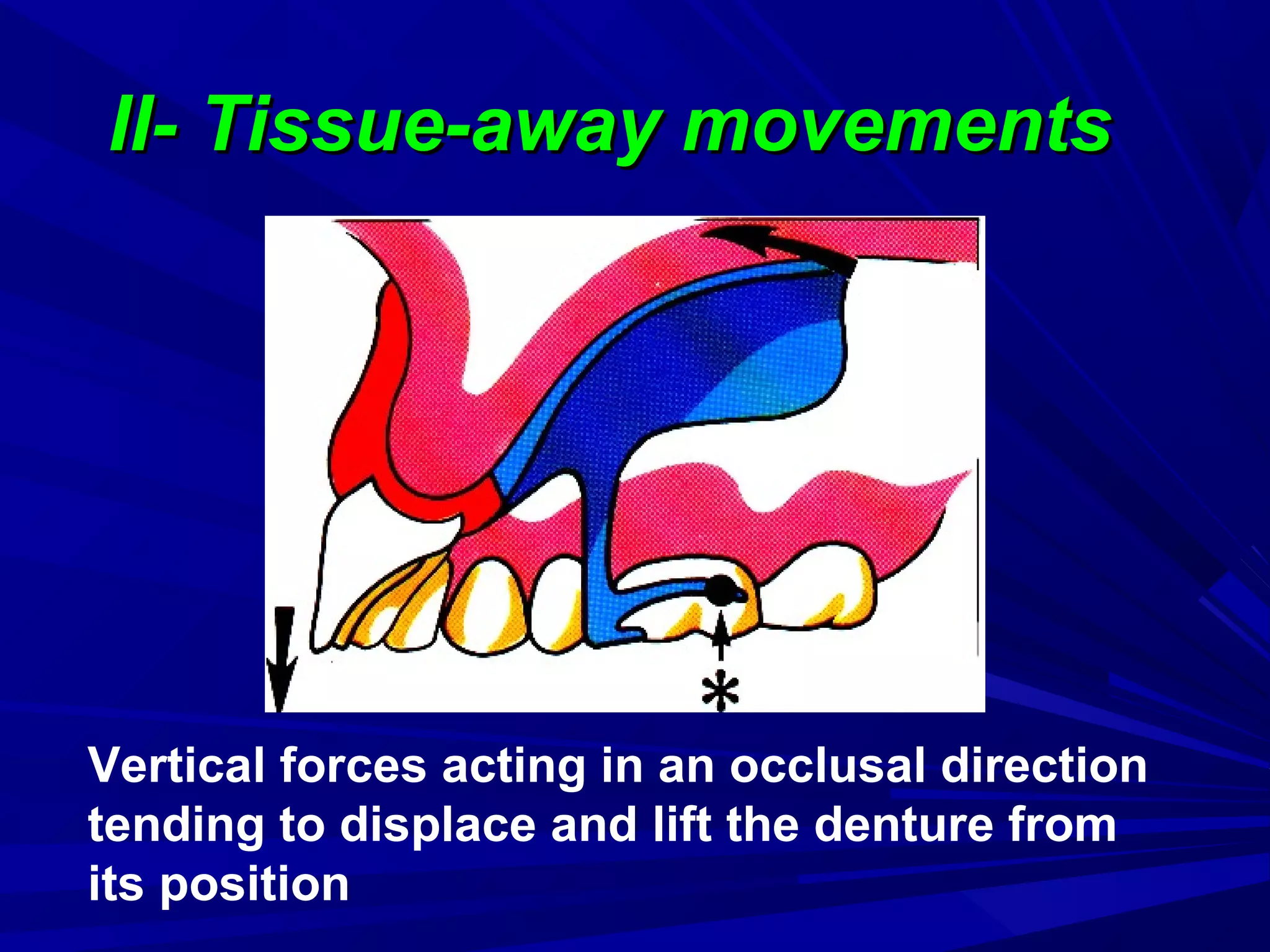 1. forces acting on rpd | PPT