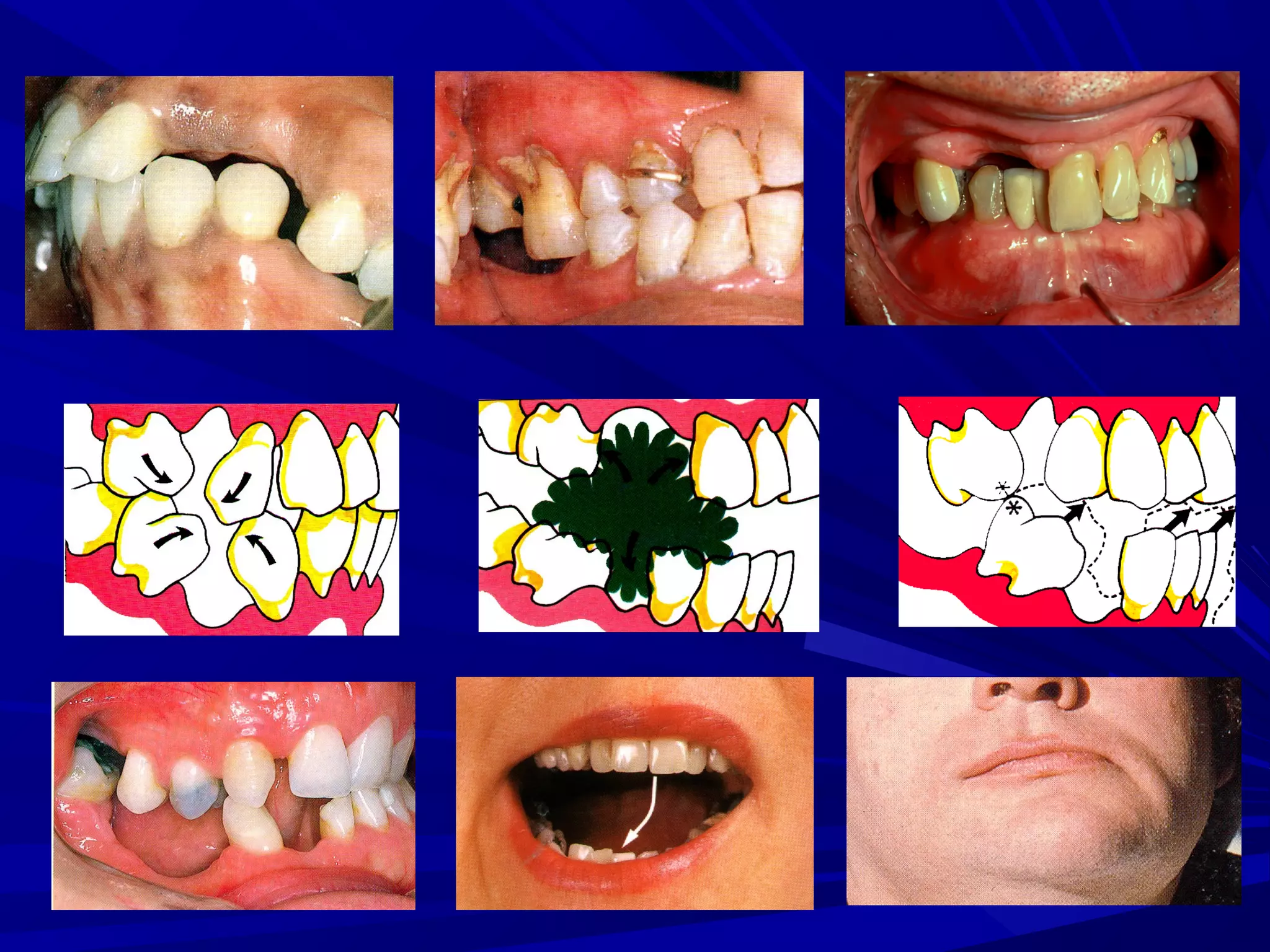 1. forces acting on rpd | PPT