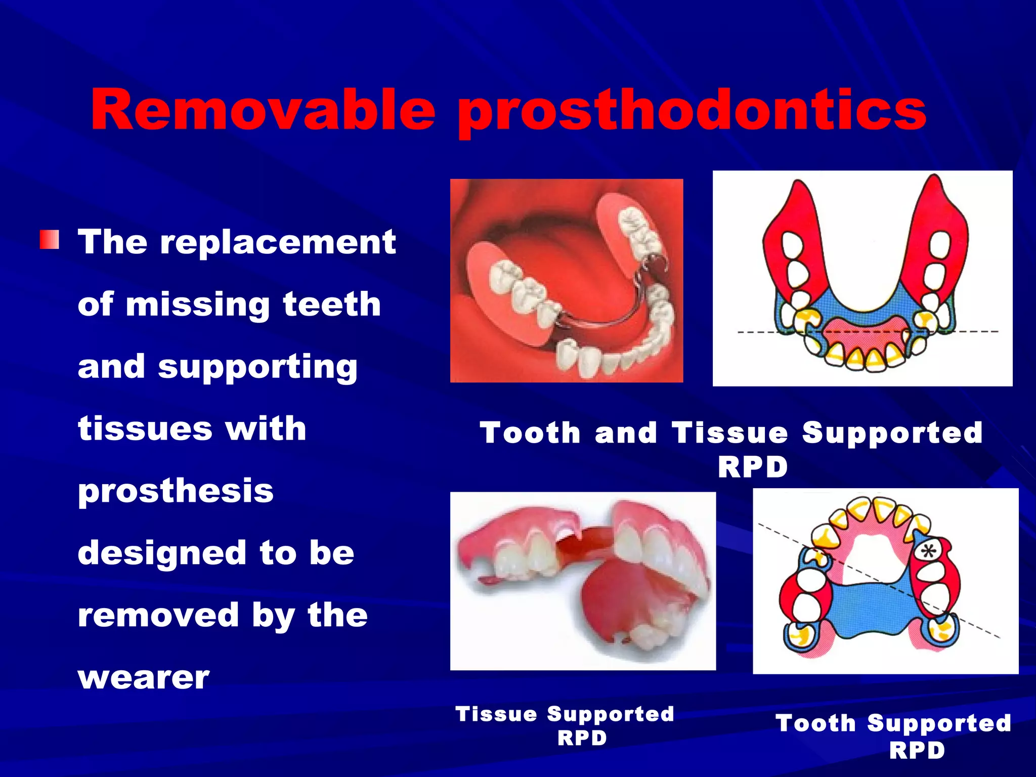 1. forces acting on rpd | PPT