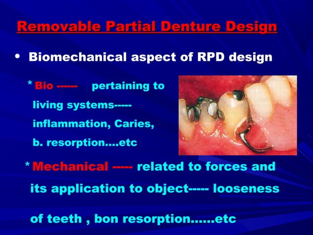 1. forces acting on rpd | PPT