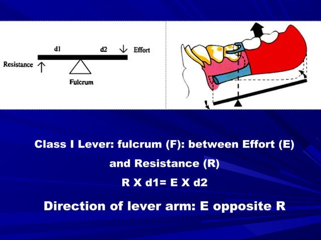 1. forces acting on rpd | PPT