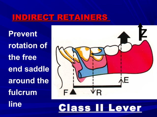 1. forces acting on rpd | PPT