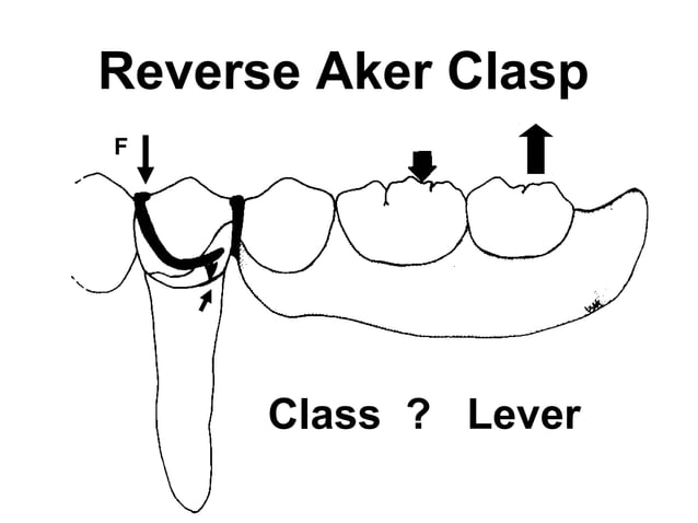 1. forces acting on rpd | PPT