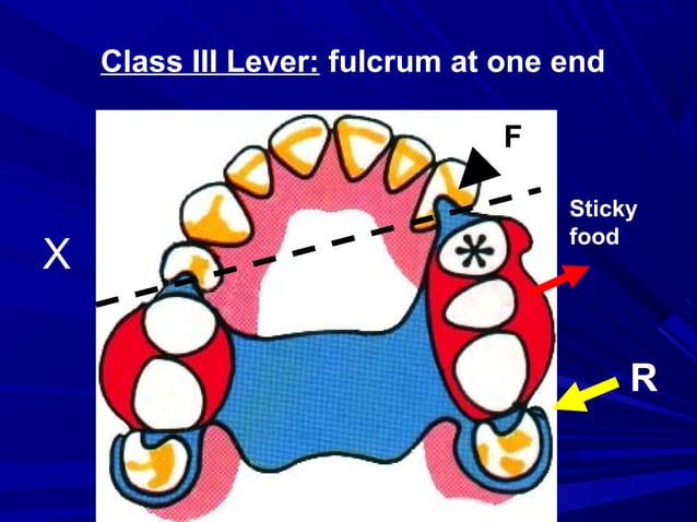 1. forces acting on rpd | PPT