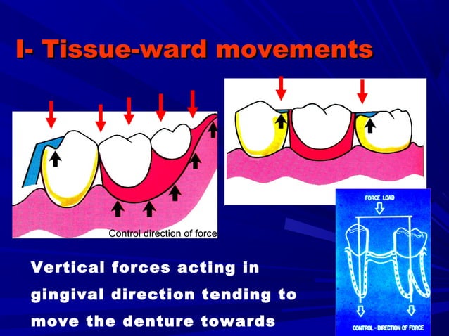 1. forces acting on rpd | PPT