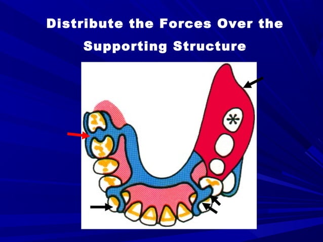1. forces acting on rpd | PPT