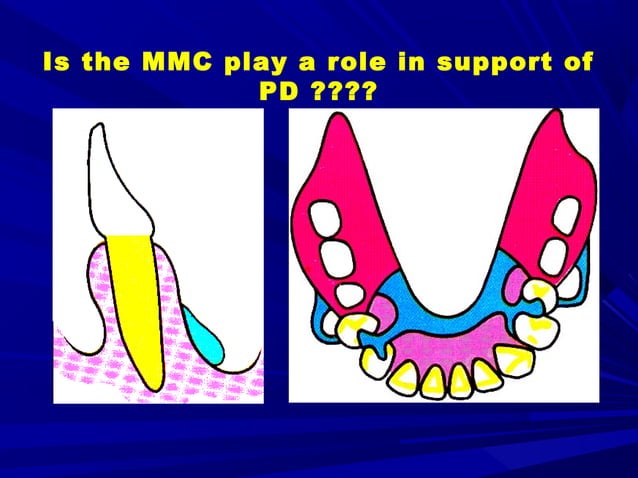 1. forces acting on rpd | PPT