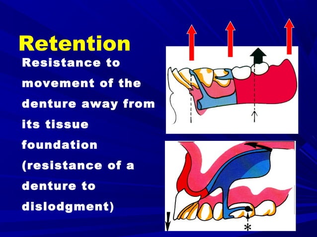 1. forces acting on rpd | PPT