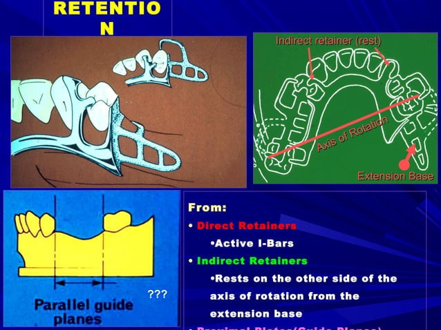 1. forces acting on rpd | PPT