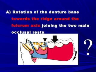 1. forces acting on rpd | PPT