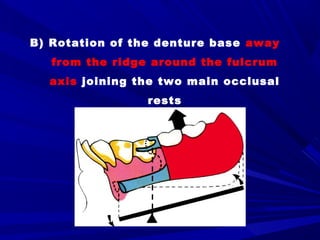 1. forces acting on rpd | PPT