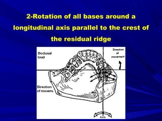 1. forces acting on rpd | PPT