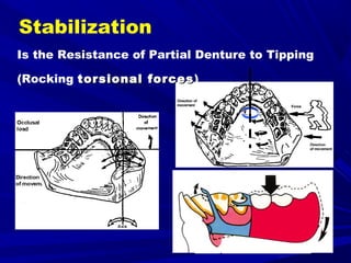 1. forces acting on rpd | PPT