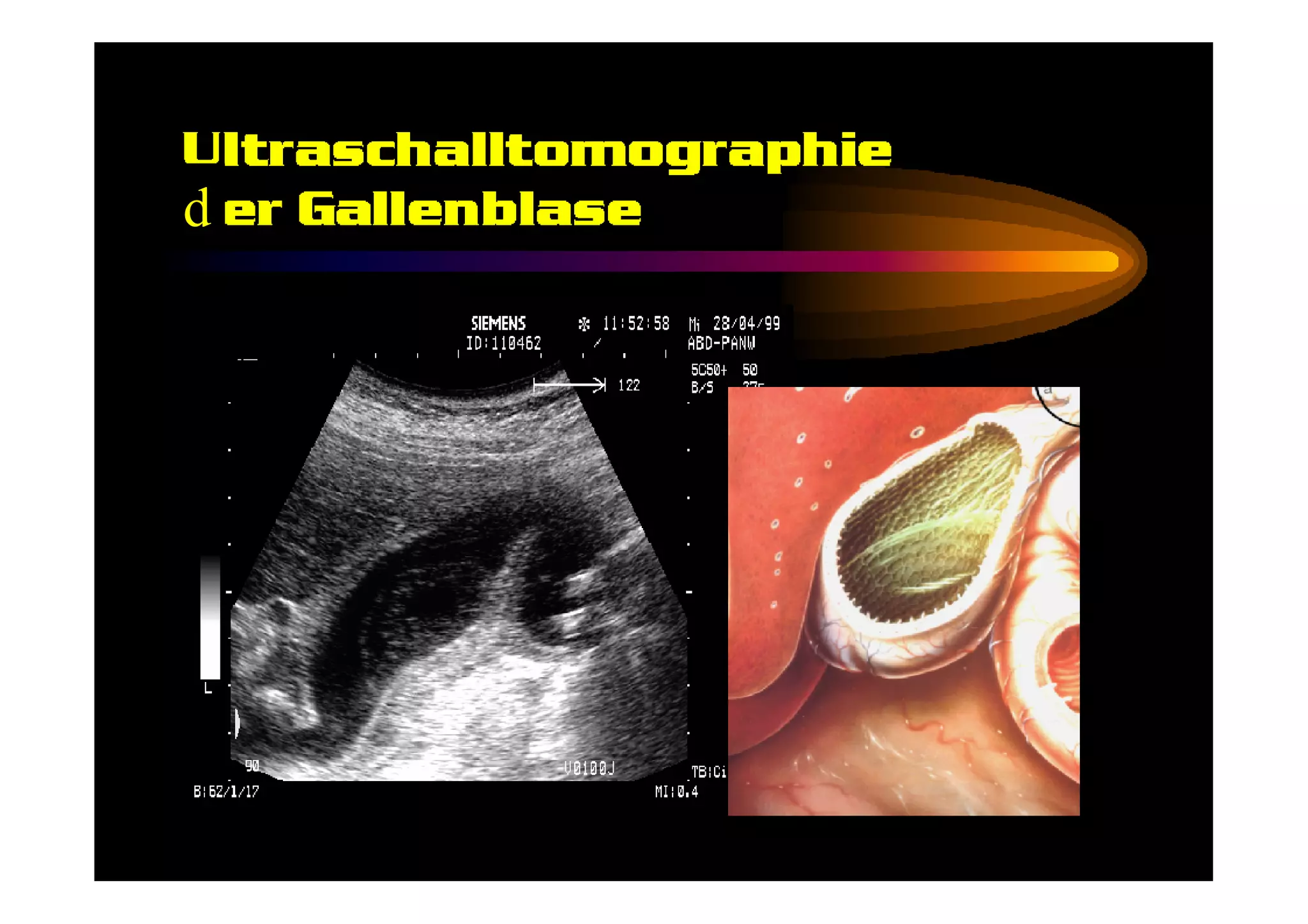 02 Sonographie der Gallenblase. Die Gallenblase. Die chronische ...