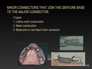 mejor connectors in removable partial dentures | PPT