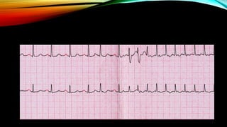 ELECTROCARDIOGRAPHY(ECG)_Autosaved.pptx. | PPTX