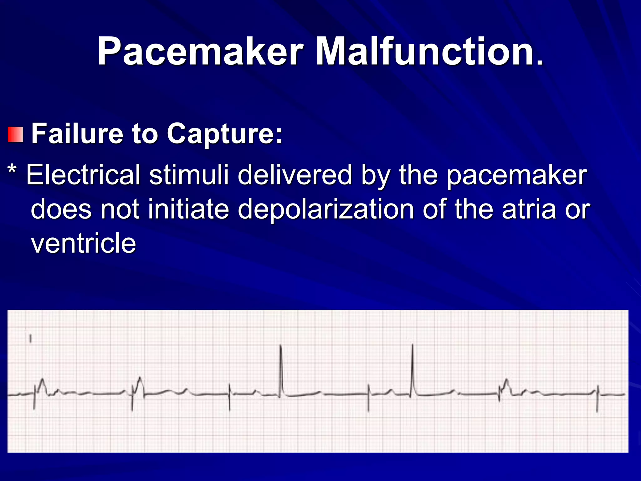 02 pacemakers and ic ds an overview-samir rafla | PPT