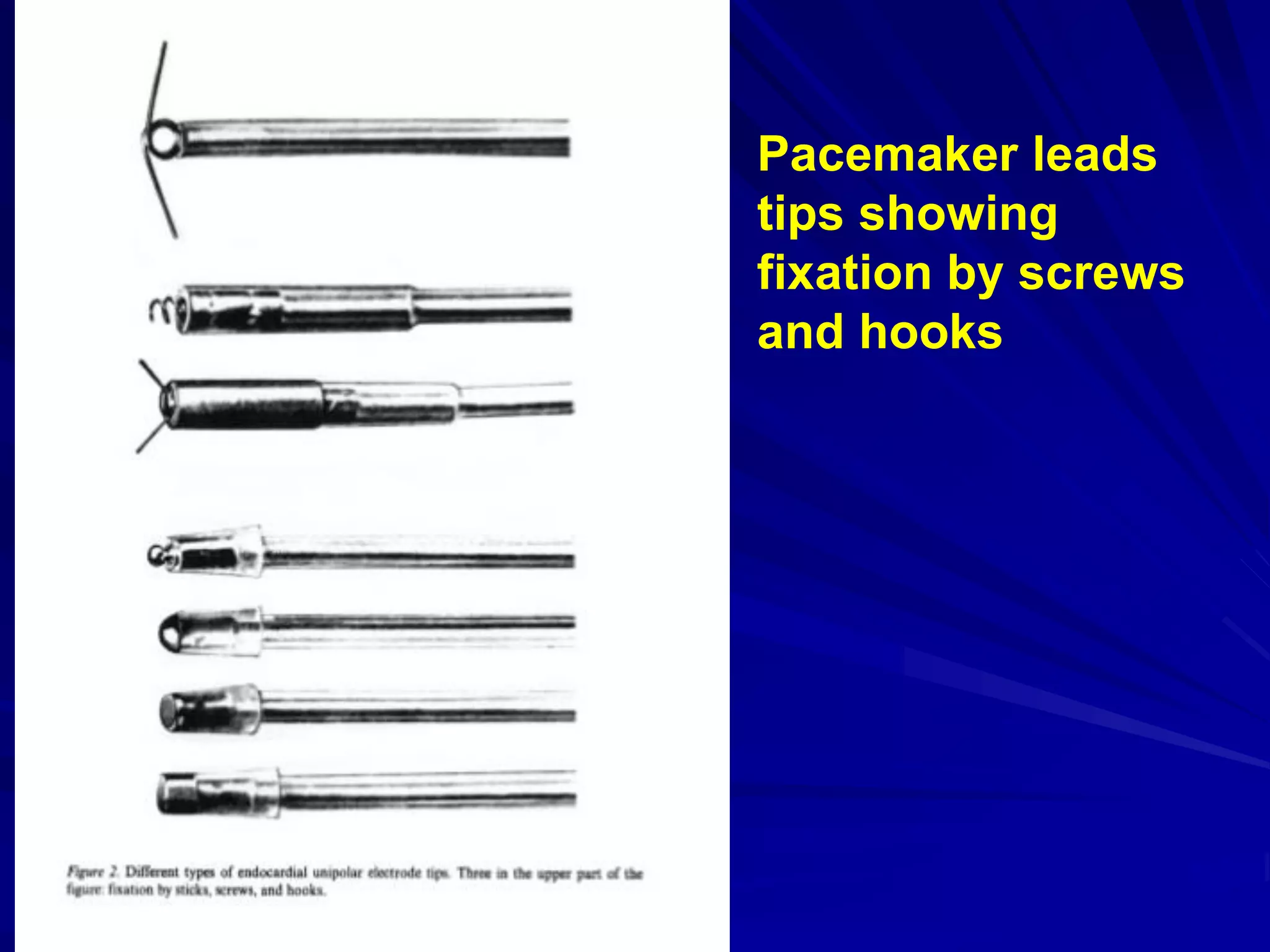 02 pacemakers and ic ds an overview-samir rafla | PDF