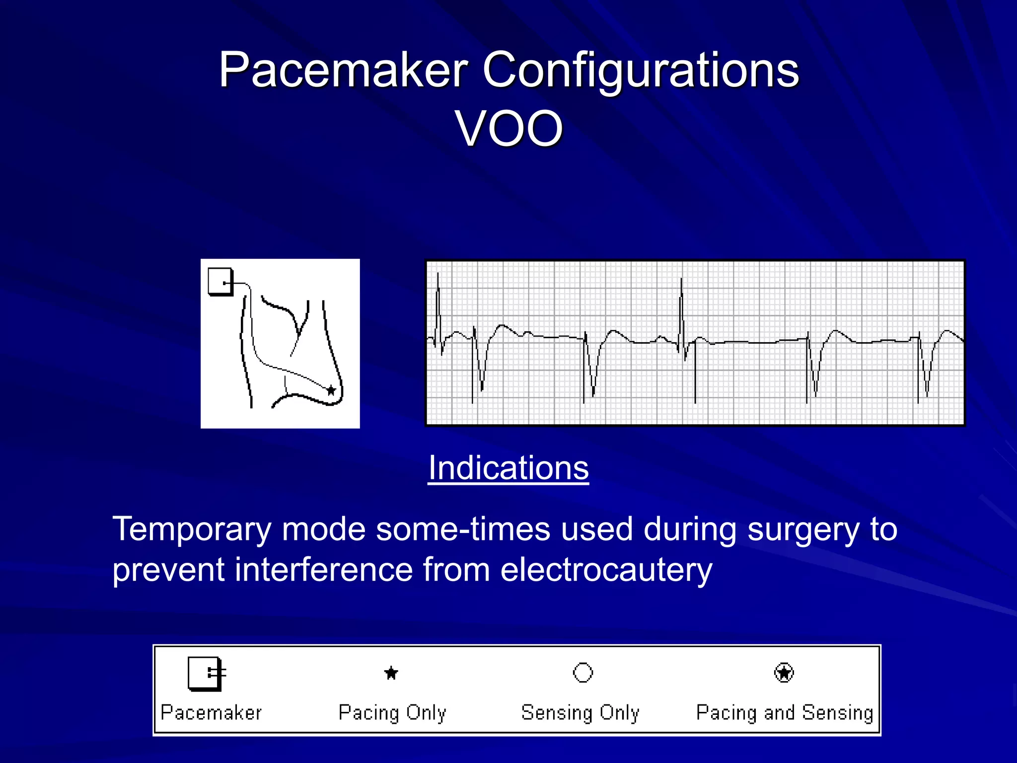 02 pacemakers and ic ds an overview-samir rafla | PPT
