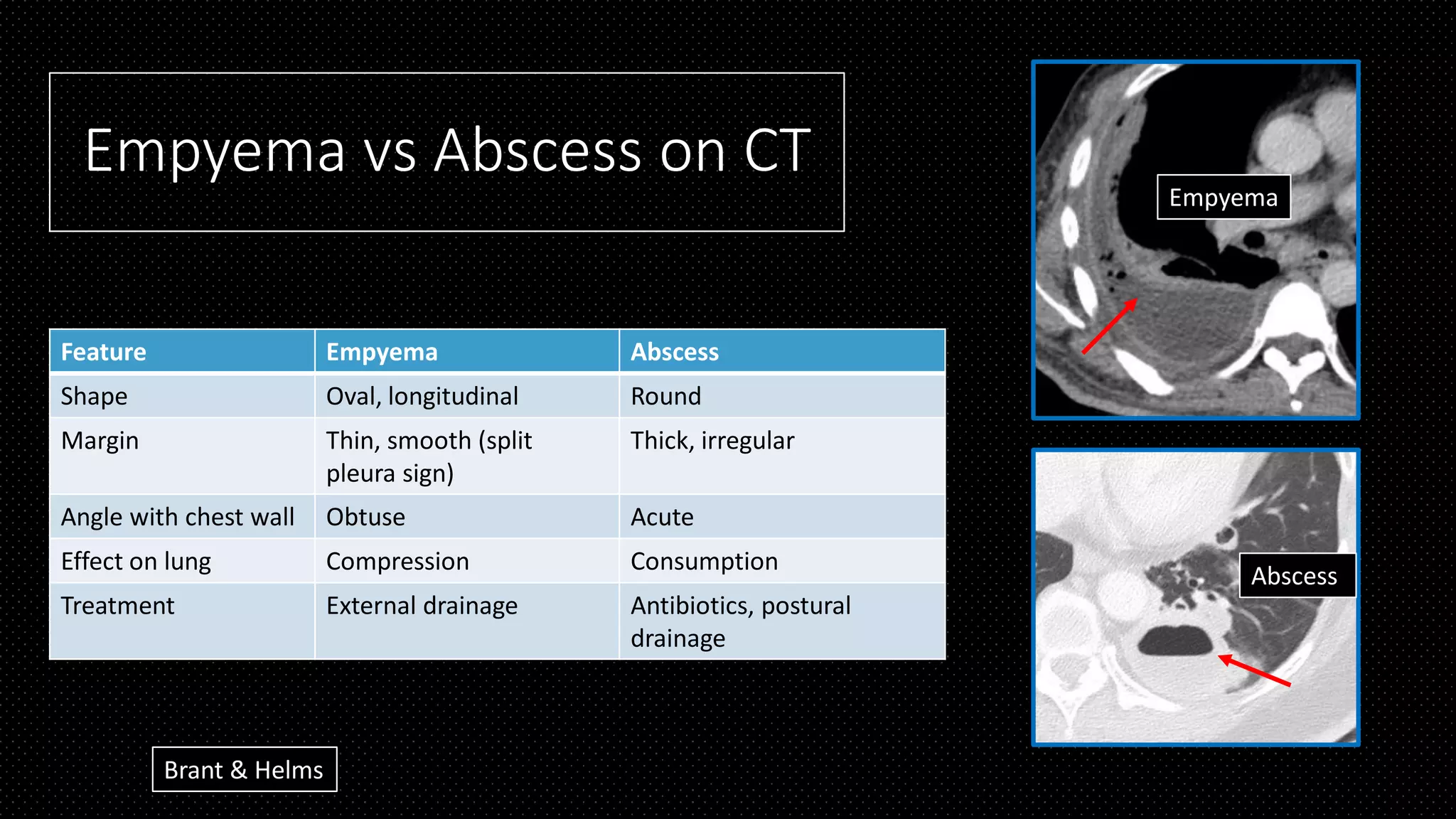 02 pleural disease 2019 radiology | PDF