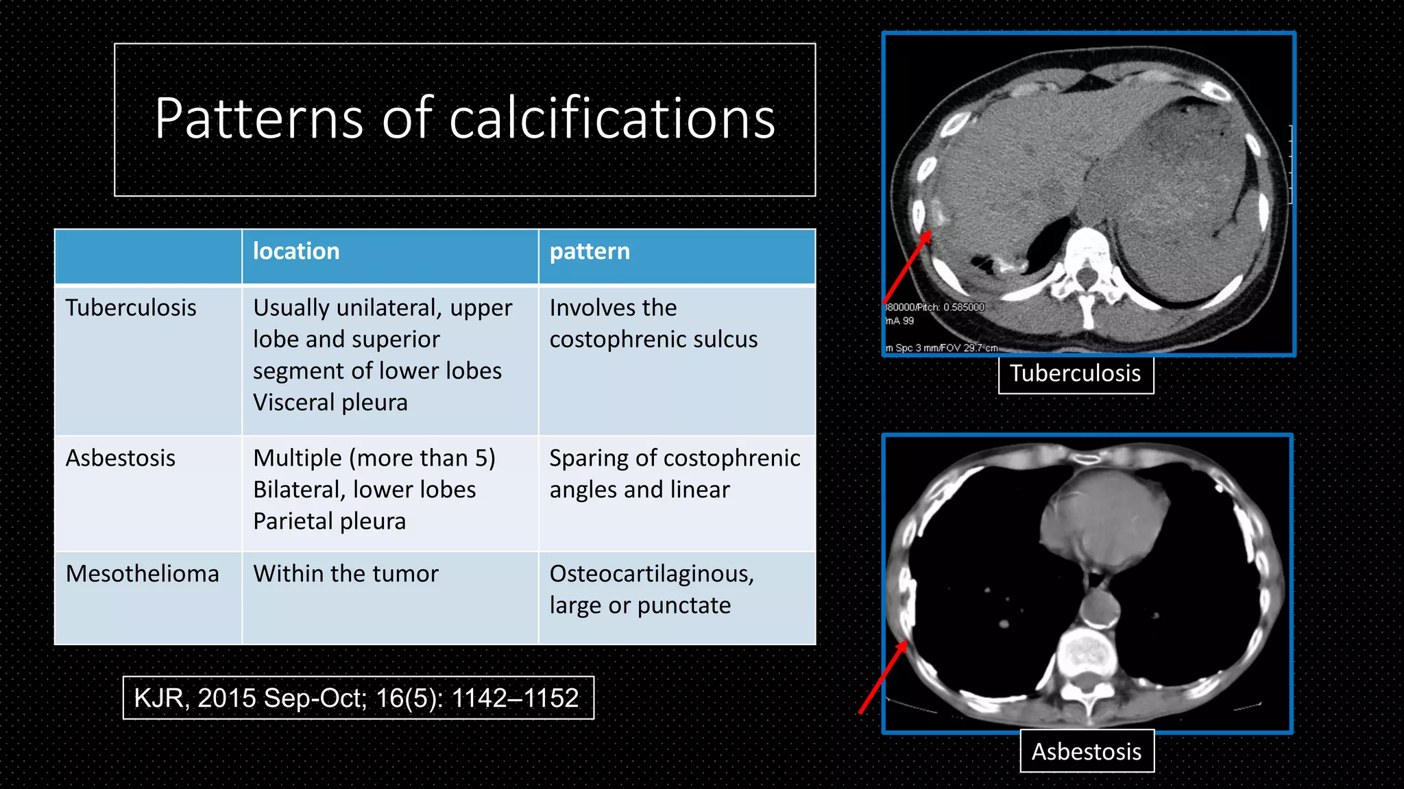 02 pleural disease 2019 radiology | PDF