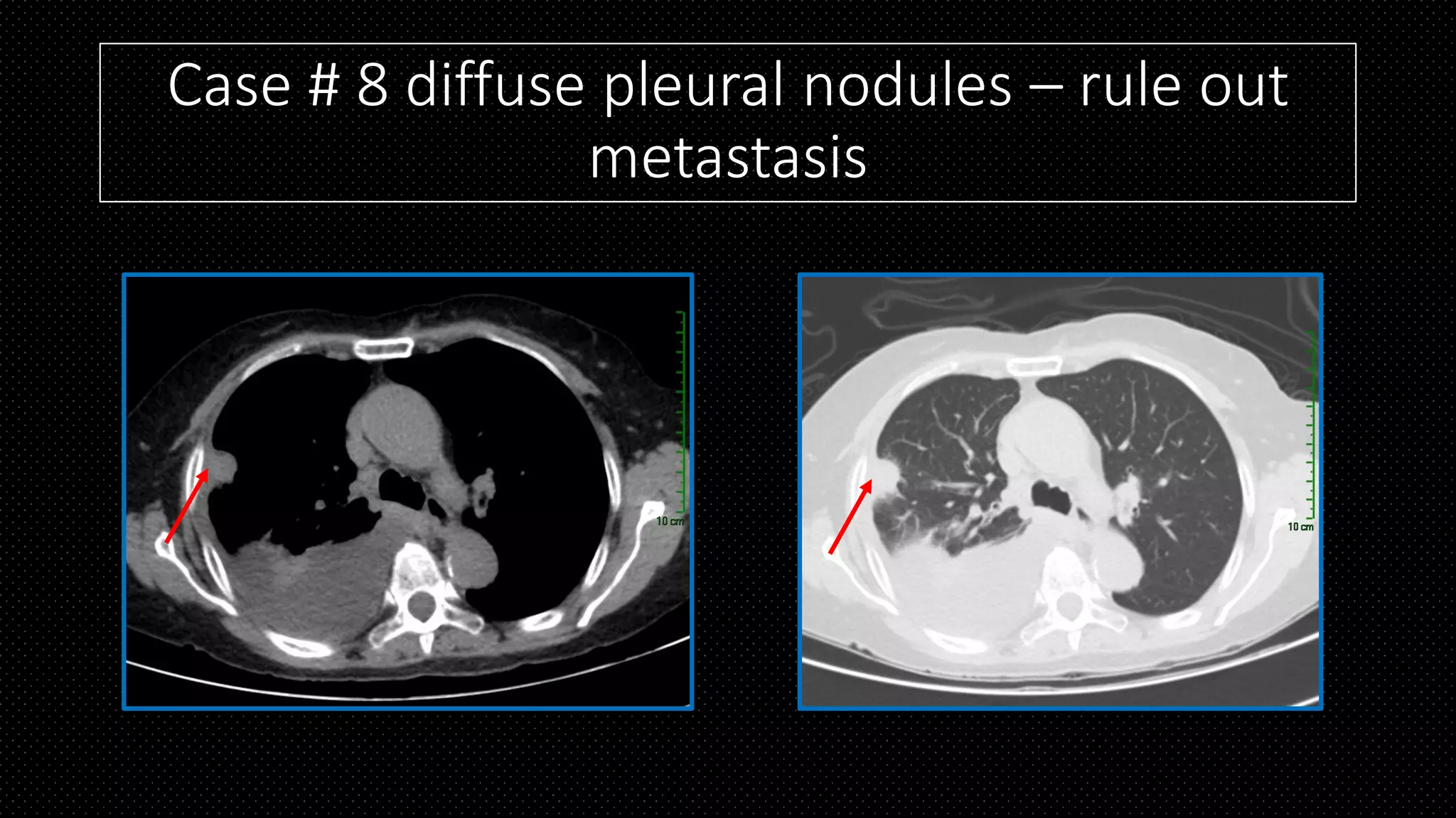 02 pleural disease 2019 radiology | PDF