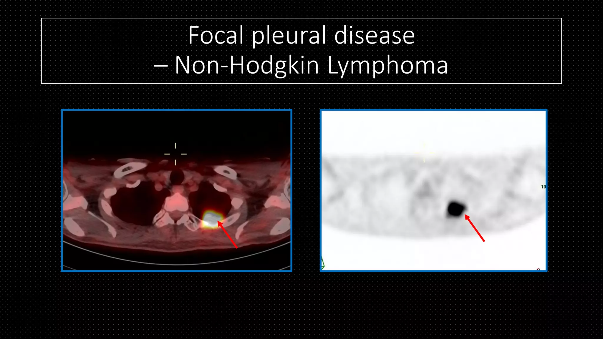 02 pleural disease 2019 radiology | PDF
