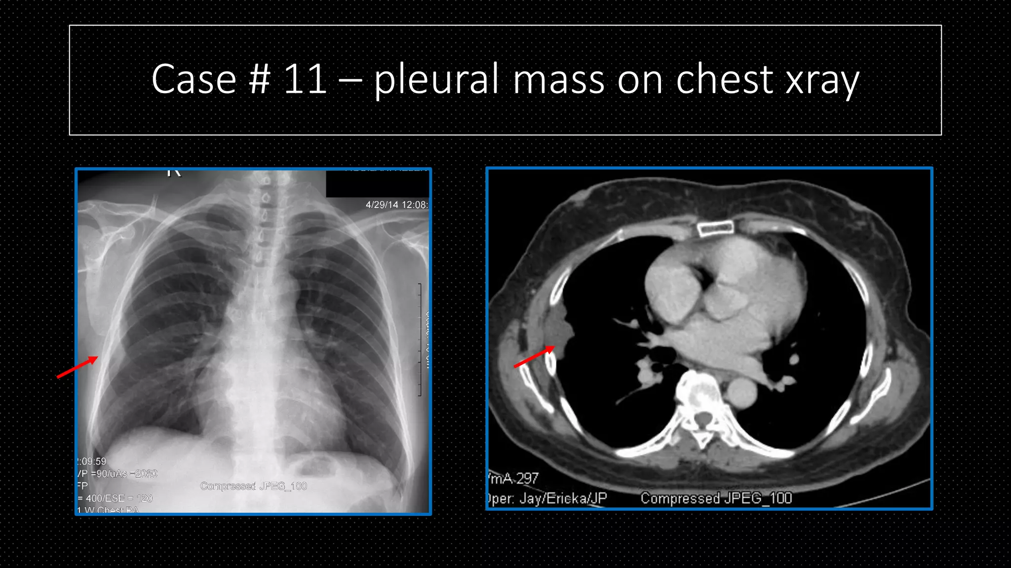 02 pleural disease 2019 radiology | PDF